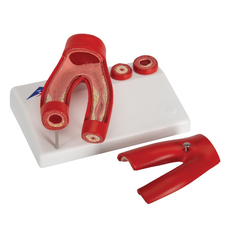 2-Part Atherosclerosis Model w/ Artery | Health and Care